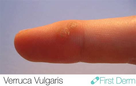 Verruca Vulgaris Common Warts First Derm