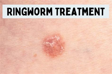 Ringworm Treatment How To Get Rid Of Ringworm