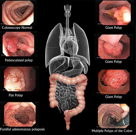 Colorectal Tumours Mind The Bleep