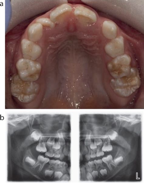 6 Year Molars Teeth Tooth Eruption Chart And Timeline Pcwe