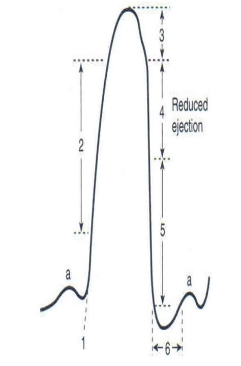 Ventricular Waveform Diagram Quizlet