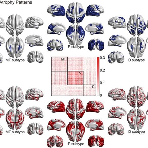 Cortical Atrophy Patterns For Three Ad Subtypes Using The Smc Dataset
