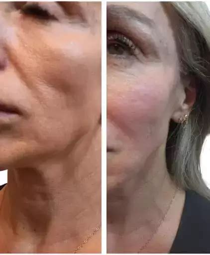 Autologous Volumizer Face And Body Cellenis® Derma Prp