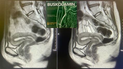 How Buscopan Boosts Abdominal Mri Scans Erjon Karaj Posted On The