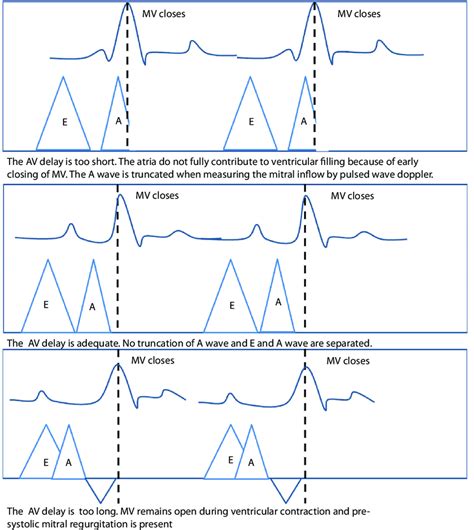 Echocardiographic Optimization Of Atrioventricular Delay Using The