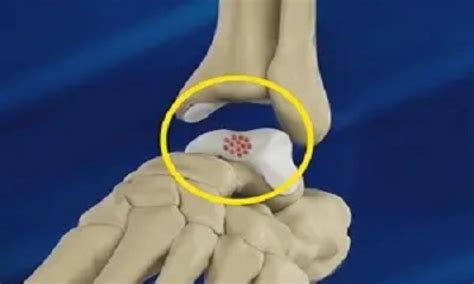 Orthopedic Cartilage Repair Market May Set New Growth Story Acera