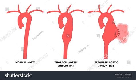 Left Subclavian Artery