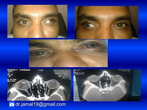 Myectomy Non Suture Technique For Large Angle Strabismus Surgery Ppt