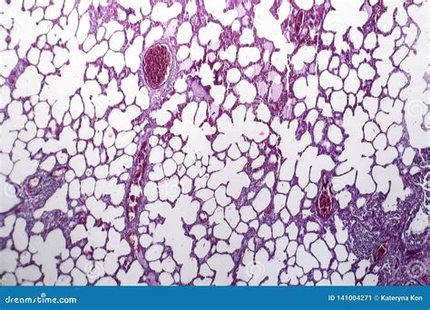 Pneumonia Light Micrograph Stock Image Image Of Micrograph Microbe