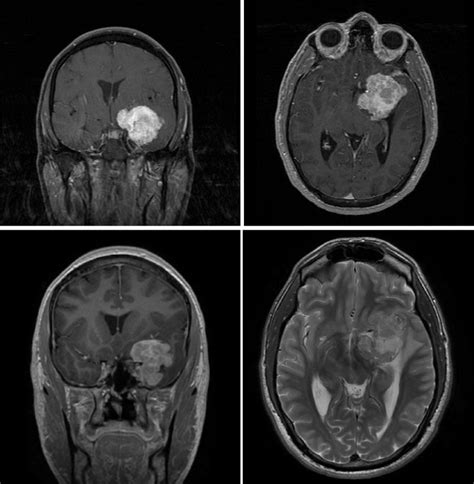 Left Temporal Meningioma