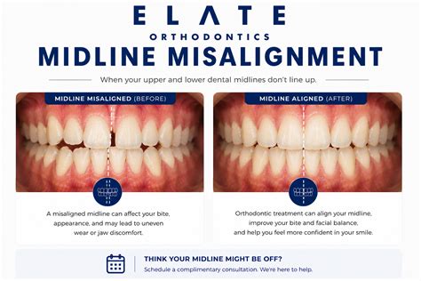 Midline Misalignment Frisco And The Colony Orthodontist