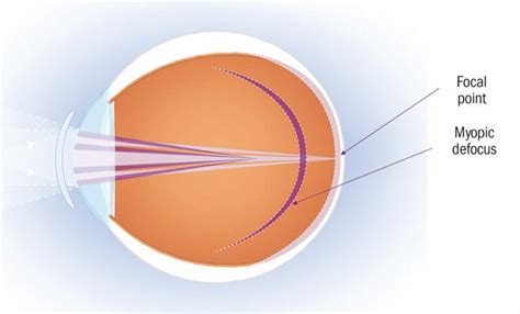 Misight 1 Day Cls For Myopia Control Three Year Milestone Results