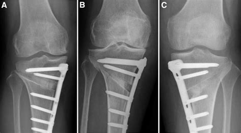 In Osteoclasis A Bone Is