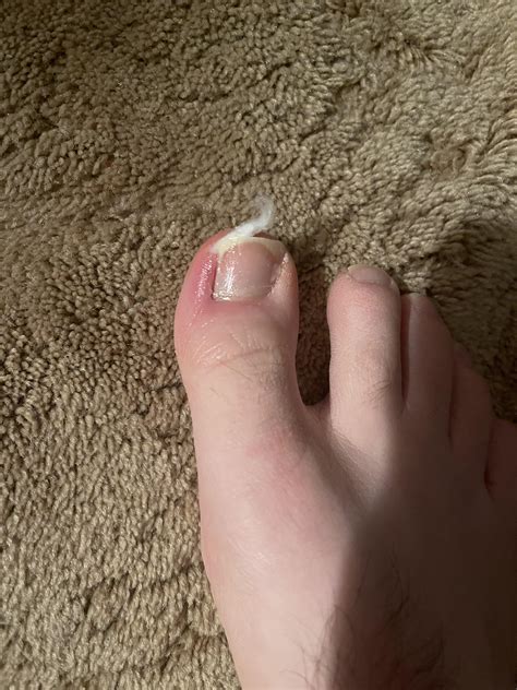 Partial Toenail Removal What Does A Partial Matricectomy Look Like