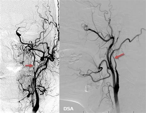 Arterial Dissection Stroke Manual