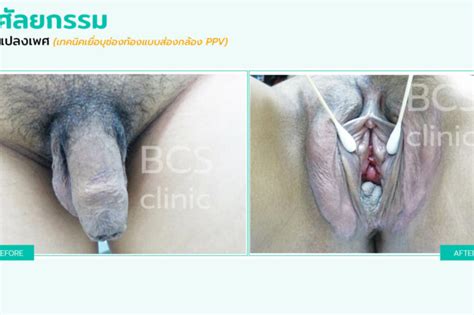 ผ่าตัดแปลงเพศ เทคนิคเยื่อบุช่องท้องแบบส่องกล้องppv Bcs Reviews