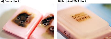 A Next Generation Tissue Microarray Ngtma Protocol For Biomarker Studies