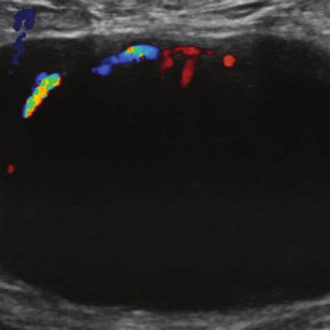 Mammogram Of The Right Breast A With Tomosynthesis Spot Compression
