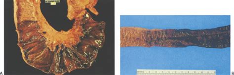 Ischemic Enteritis Abdominal Key