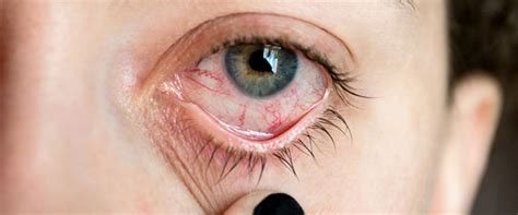 Eyes Bloodshot Coughing At Jack Belser Blog