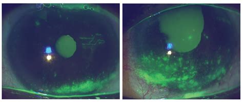 All Roads Lead To Dry Eye