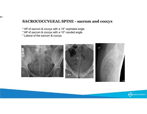 Sacrum And Coccyx X Ray