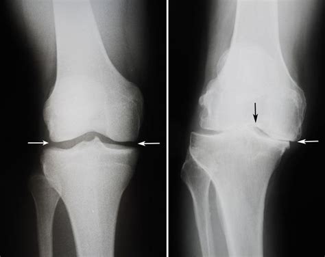 The Role Of Knee Arthroscopy Knee Replacements In London