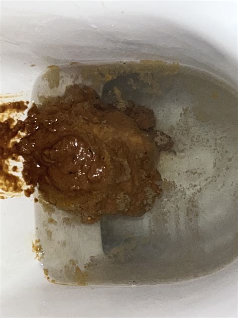 Is This Fatty Stool Look At All The Film Oily Look A Like Substance