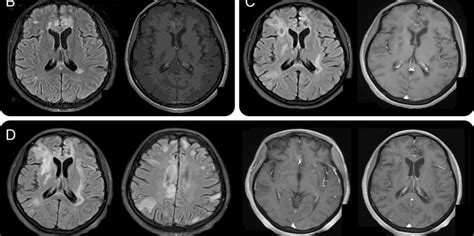 Schizophrenia Is Chronic Encephalitis Utopia Silver
