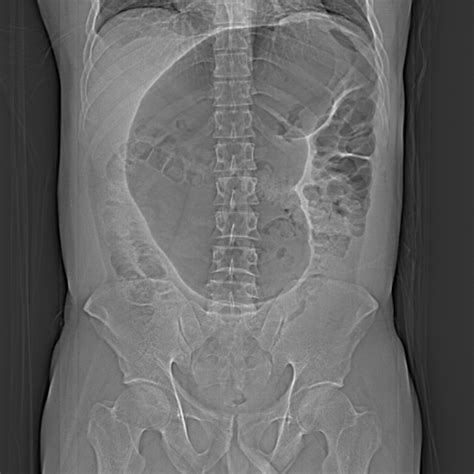 Closed Loop Obstruction Radiology Reference Article