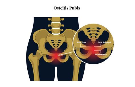 Osteitis Pubis Treatment In Singapore Cove Orthopaedic Clinic Cove Orthopaedic Clinic