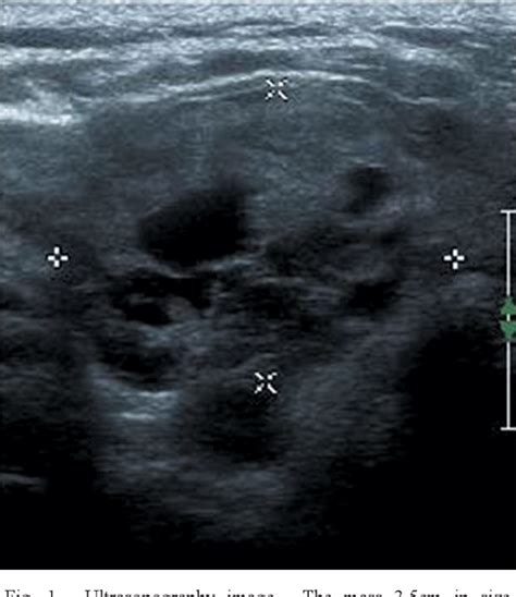 Table 1 From A Case Of Plummer Disease Treated With Radioiodine Therapy