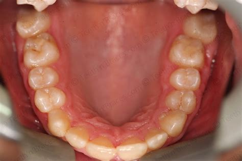 Case 12 Overlapping And Big” Front Teeth Teeth N Braces