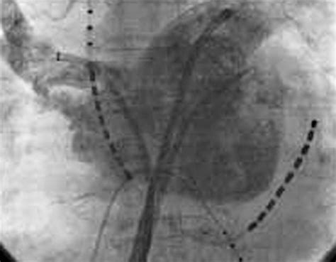 Atrial Cardioversion System Beeat Shock At Products Japan