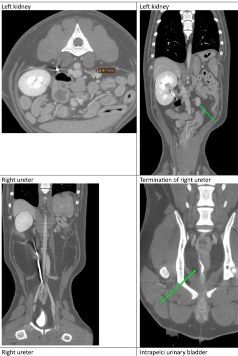 Svs Imaging On Linkedin Right Ectopic Ureter With Termination At The