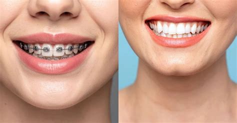 Braces Before And After Guide And Tips Vitrin Clinic