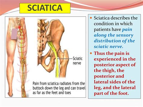 Sciatic Nervepdf Physiotherapy Treatment Ppt
