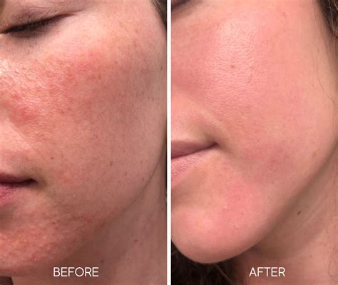 Lumielle Glass Skin Liquid Exfoliant Rachael Rosewood Skin Clinic