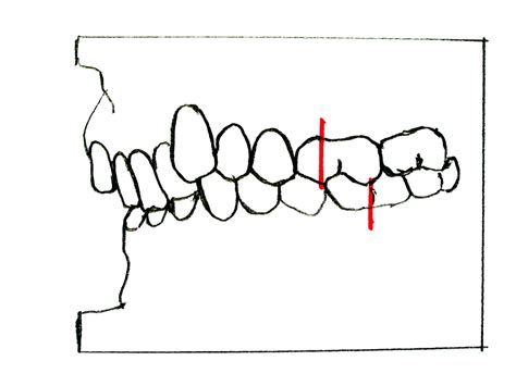 Angles Classification Of Malocclusions Examinedental