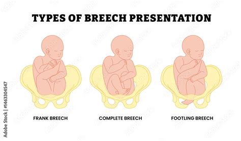Different Types Of Breech Presentation Types Educational Medical Poster Design Healthcare