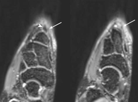 Extensor Hallucis Longus Mri Mri Of The Ankle Detailed Anatomy