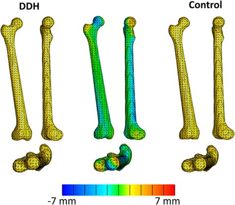 Statistical Shape Modeling Of Femur Shape Variability In Female Patients With Hip Dysplasia