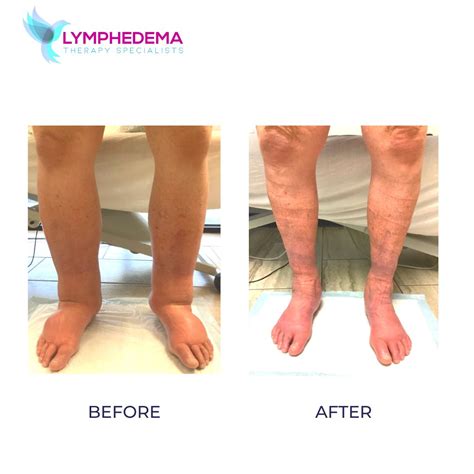 Lymphedema Compression Lymphaticdrainage Mld Linfedema