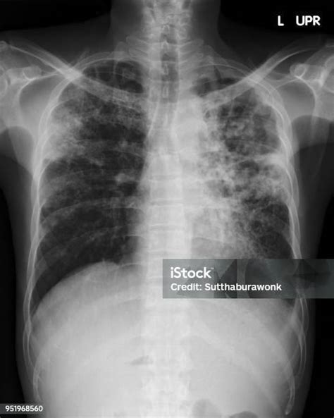 Rontgen Dada Posisi Tegak Ap Foto Stok Unduh Gambar Sekarang