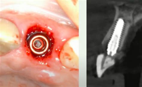 Root Shield Technique Prevents 40 Bone Loss