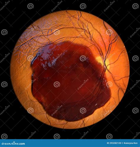 A Subretinal Hemorrhage As Observed During Ophthalmoscopy 3d Illustration Royalty Free Cartoon