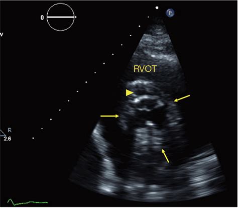 A Narrative Review Of Echocardiography In Infective Endocarditis Of The