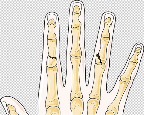 Finger Fractures Vector