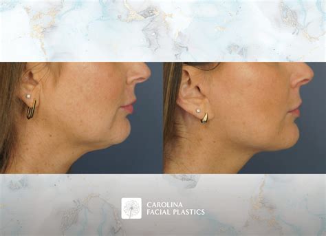 Plastic Surgery Before And After Photos Carolina Facial Plastics