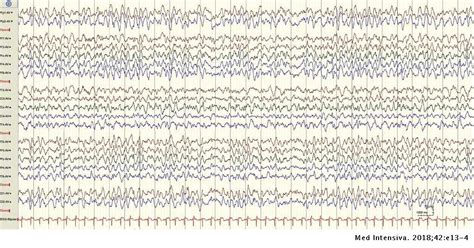 Propofol Induced Non Convulsive Epileptic Crisis Medicina Intensiva